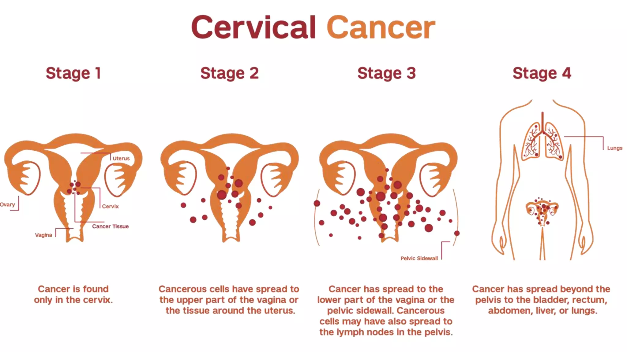 Female genital system: Fibroid, cervical cancer, endometrial cancer ...