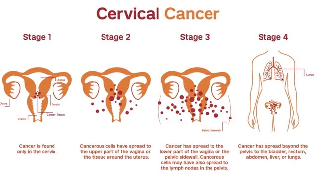 Female genital system: Fibroid, cervical cancer, endometrial cancer ...
