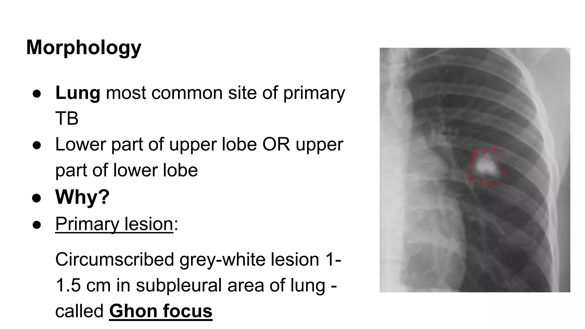 Tuberculosis, Pleural effusion - Pathology - Nursing | PPTX