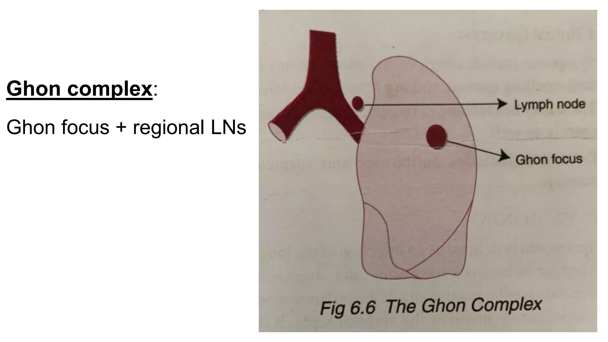 Tuberculosis, Pleural effusion - Pathology - Nursing | PPTX