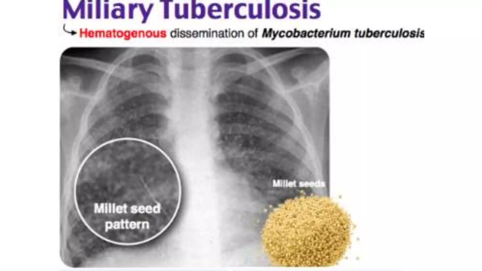 Tuberculosis, Pleural effusion - Pathology - Nursing | PPTX