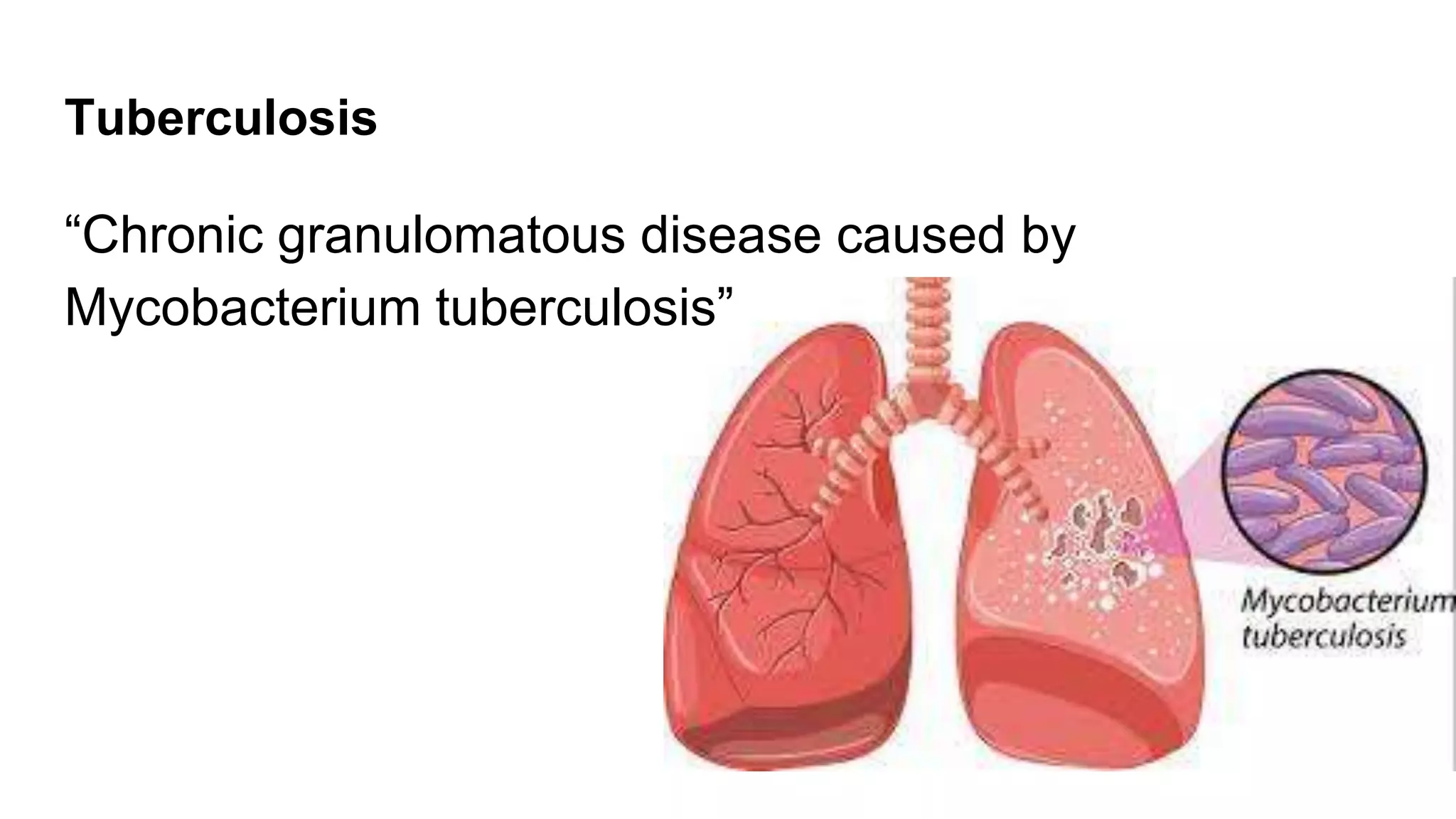 Tuberculosis, Pleural effusion - Pathology - Nursing | PPTX