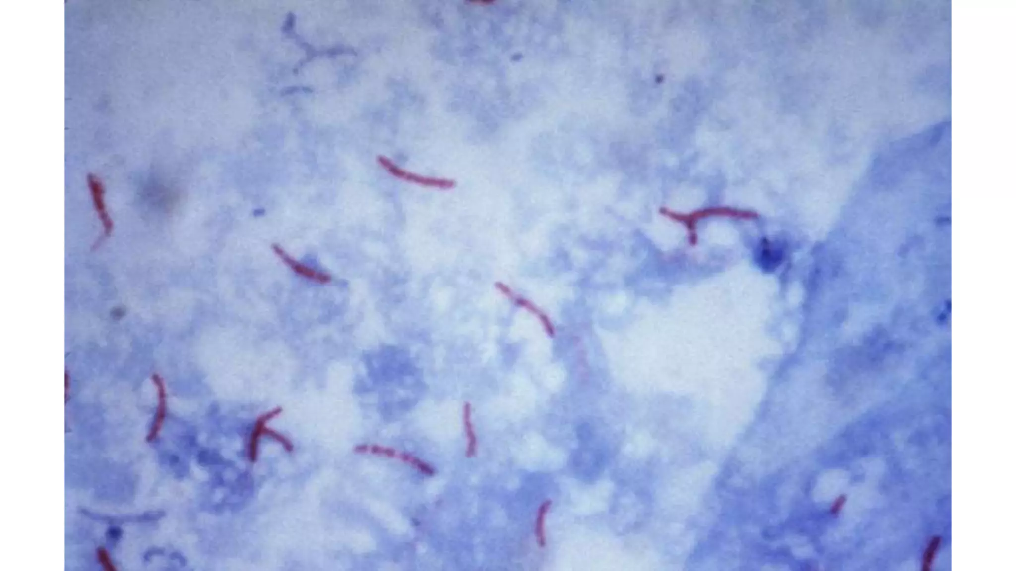 Tuberculosis, Pleural effusion - Pathology - Nursing | PPTX