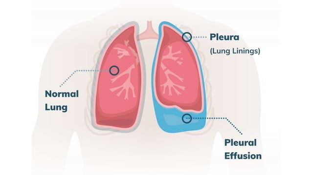 Tuberculosis Pleural Effusion Pathology Nursing Pptx Lung And