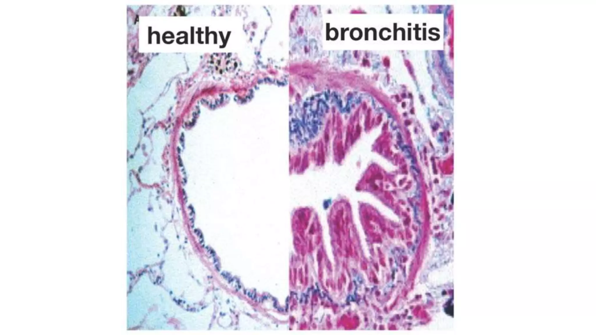 Bronchitis, Pneumonia - Pathology - Nursing | PPTX