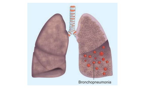 Bronchitis, Pneumonia - Pathology - Nursing | PPT