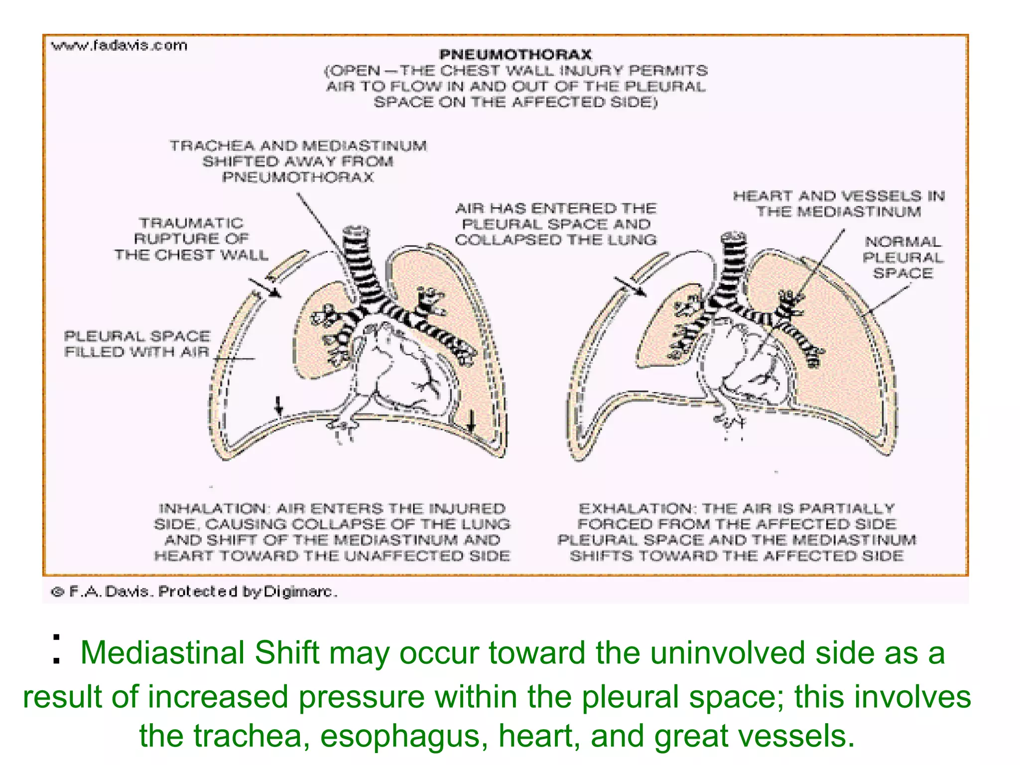 Nursing Bulletin Notes On Pneumothorax | PPT