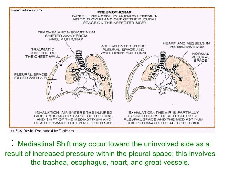Nursing Bulletin Notes On Pneumothorax