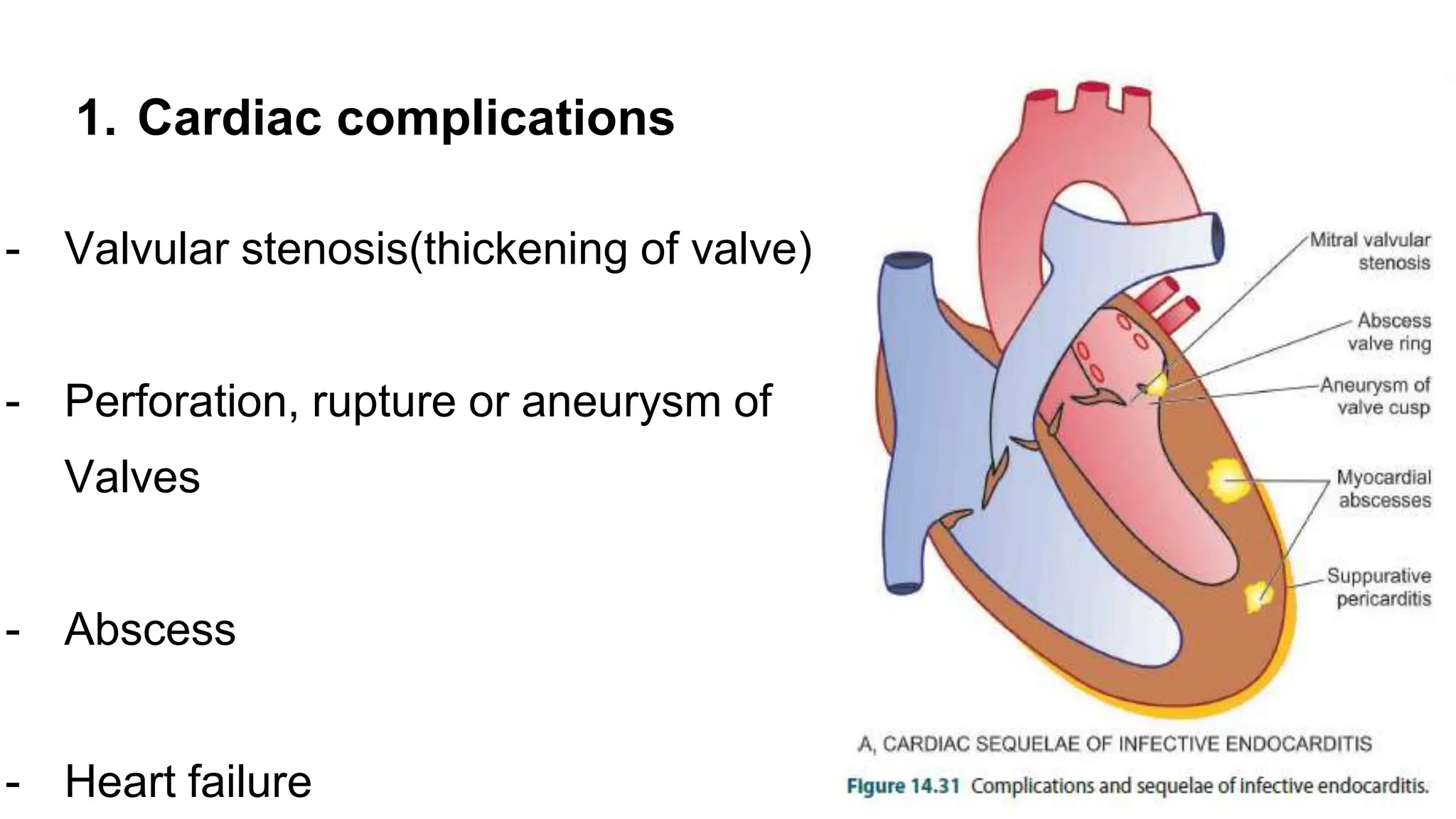 Ischemia, Infarction, Aneurysm, Atherosclerosis, Infective endocarditis ...