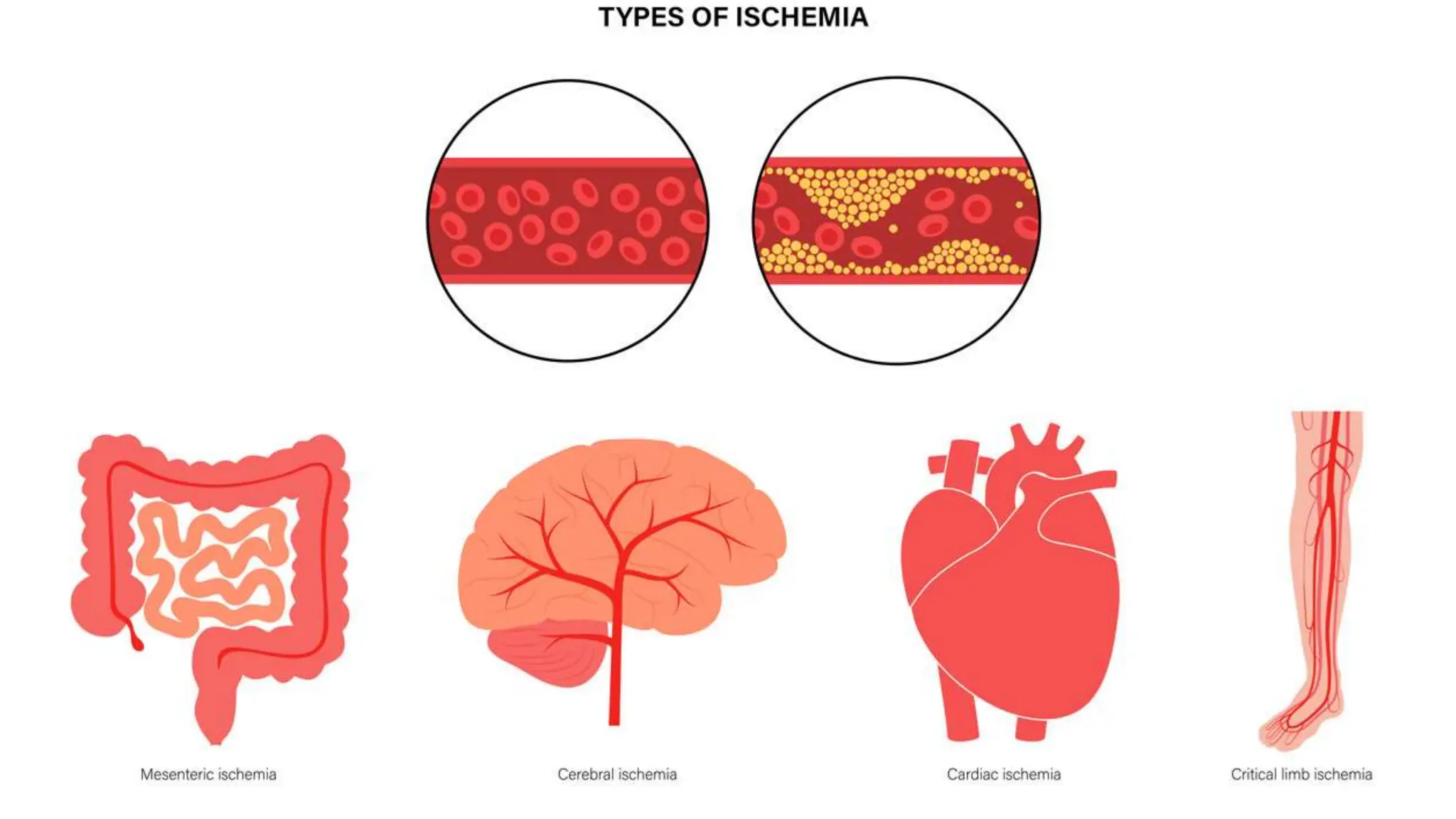 Ischemia, Infarction, Aneurysm, Atherosclerosis, Infective endocarditis ...