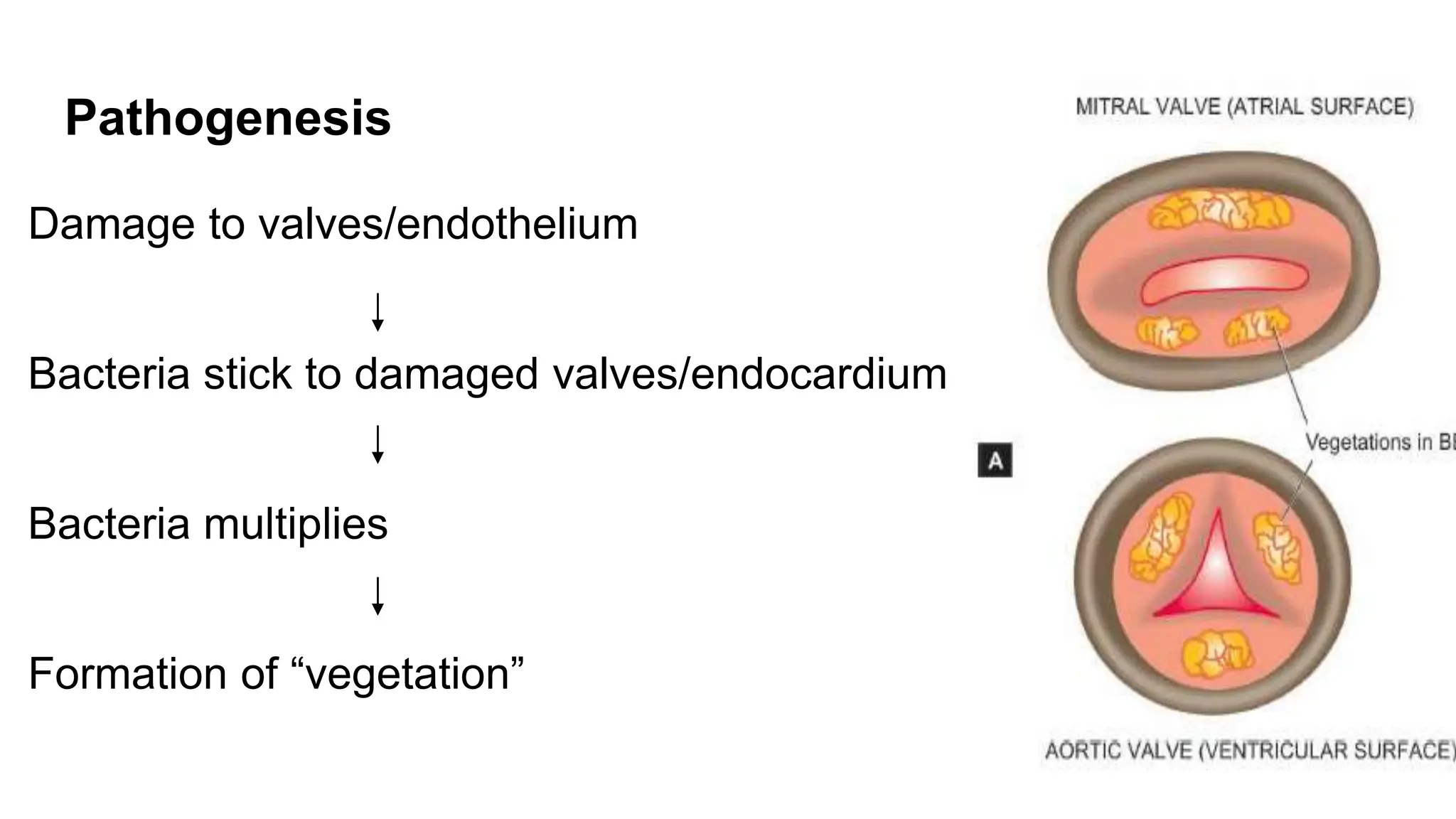 Ischemia, Infarction, Aneurysm, Atherosclerosis, Infective endocarditis ...