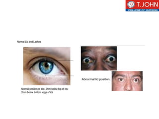 Nursing assessment of the eye | PPTX