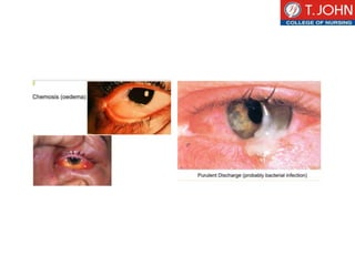 Nursing assessment of the eye | PPTX