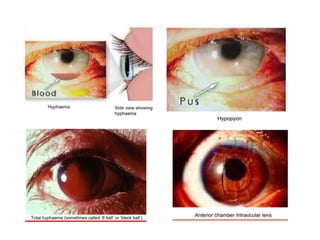 Nursing assessment of the eye | PPTX