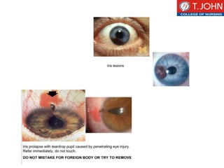 Nursing assessment of the eye | PPTX