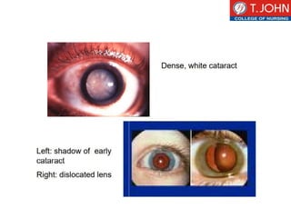 Nursing assessment of the eye | PPTX