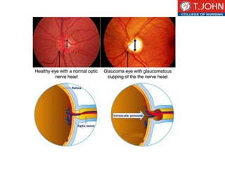 Nursing assessment of the eye | PPTX