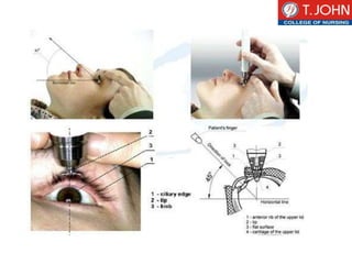 Nursing assessment of the eye | PPTX