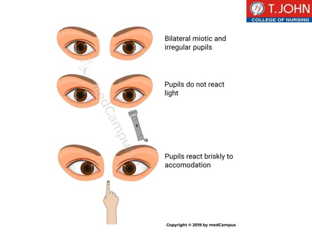 Nursing assessment of the eye