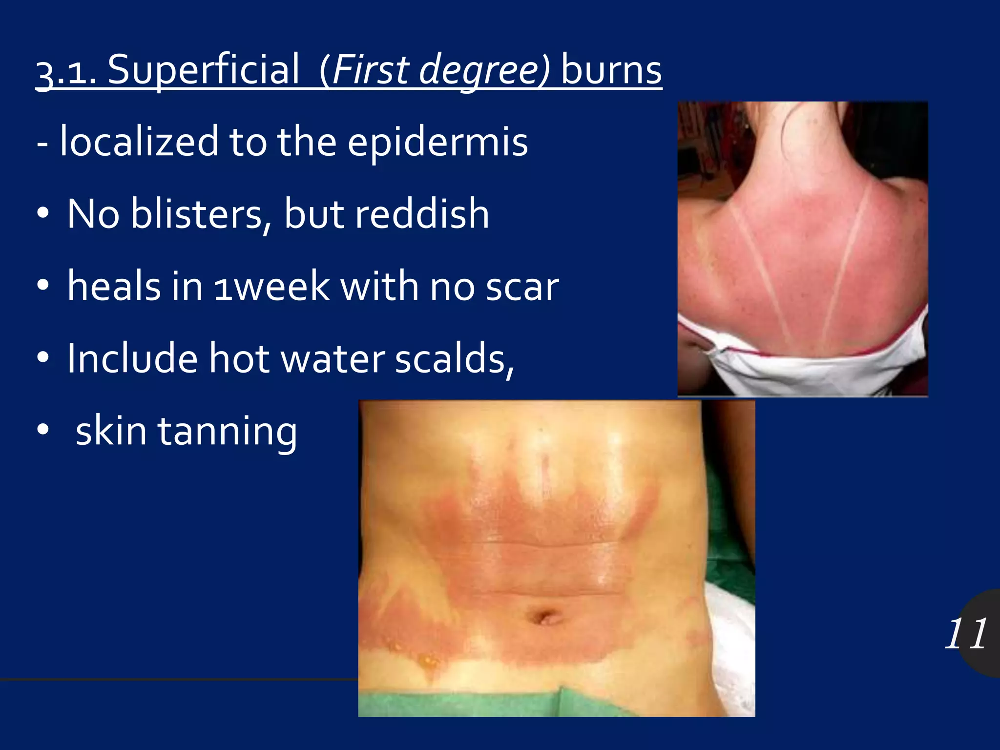 Burn Injuries: Management and Nursing Care | PDF