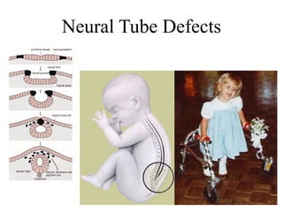 Nursing care of a child with spina bifida | PPTX