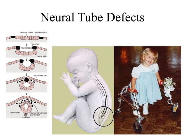 Nursing care of a child with spina bifida | PPTX | Pregnancy ...
