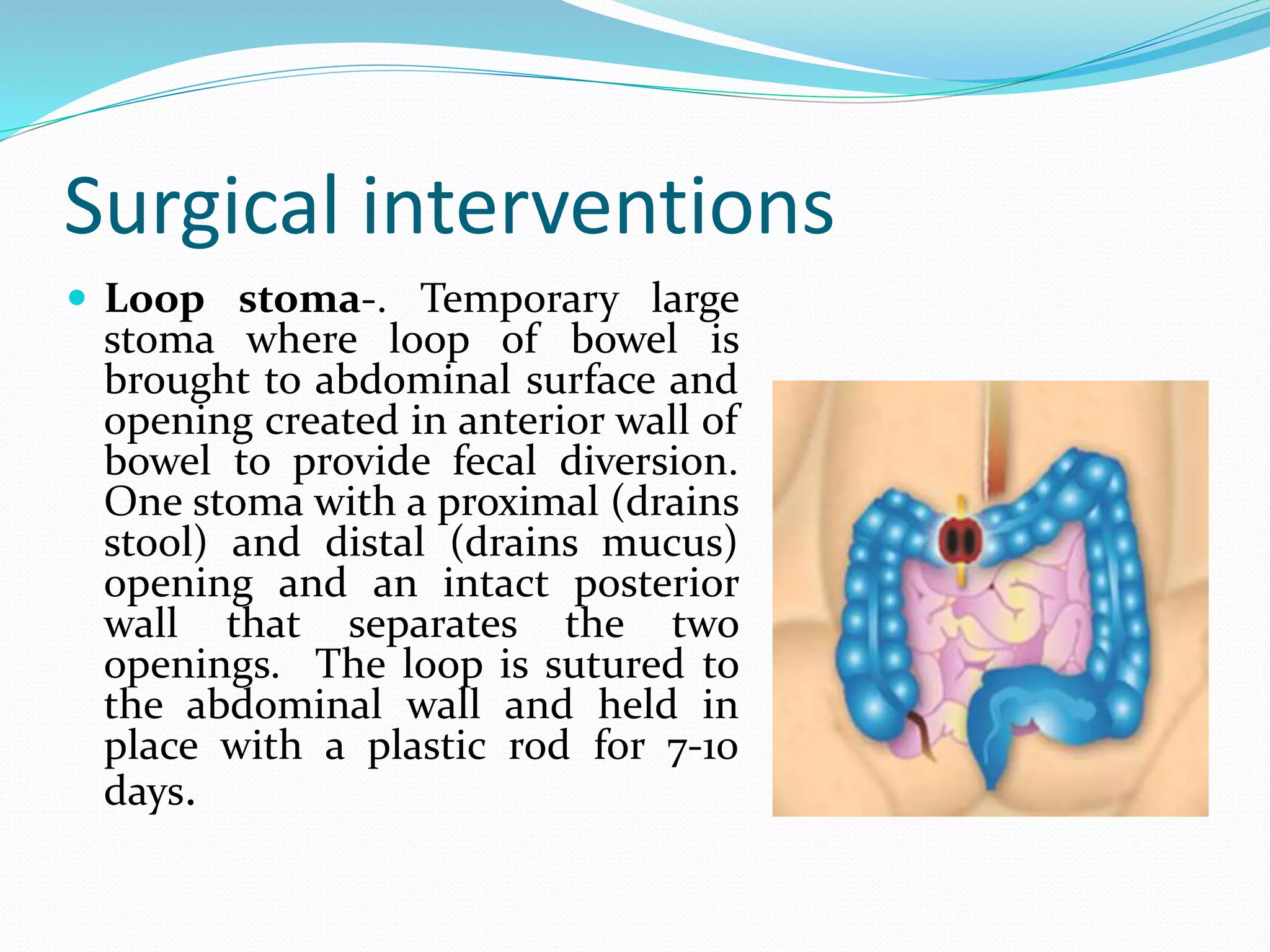 Nursing care of a child with stoma | PPTX