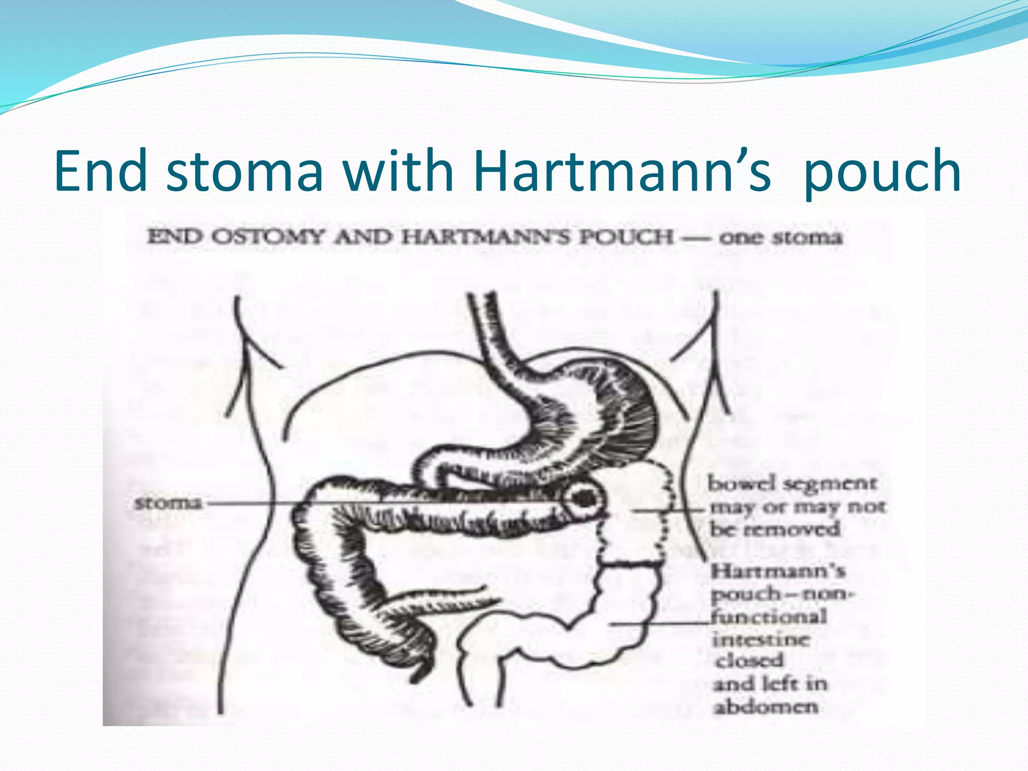 Nursing care of a child with stoma | PPTX