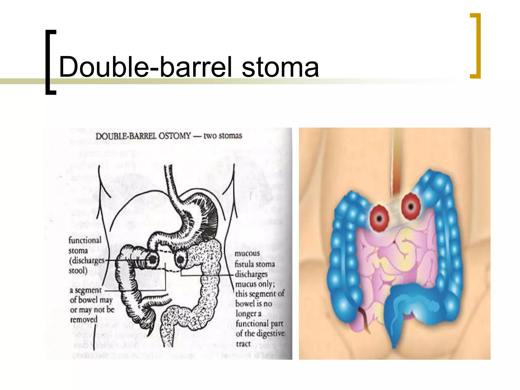 Nursing care of a child with stoma | PPTX