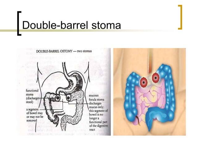 Nursing care of a child with stoma | PPTX | Digestive Disorders ...