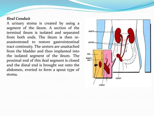 Nursing care of a child with stoma | PPTX | Digestive Disorders ...