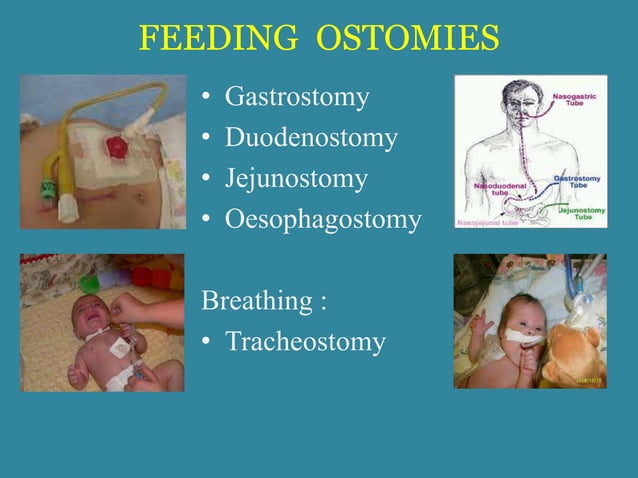 Nursing care of a child with stoma | PPTX | Digestive Disorders ...