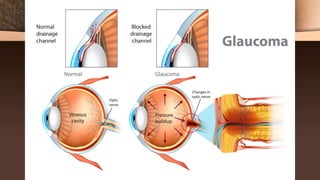 Nursing Care of Patients With Eye & Visual Disorders | PPTX