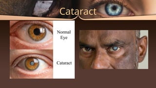 Nursing Care of Patients With Eye & Visual Disorders | PPTX