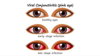 Nursing Care of Patients With Eye & Visual Disorders | PPTX