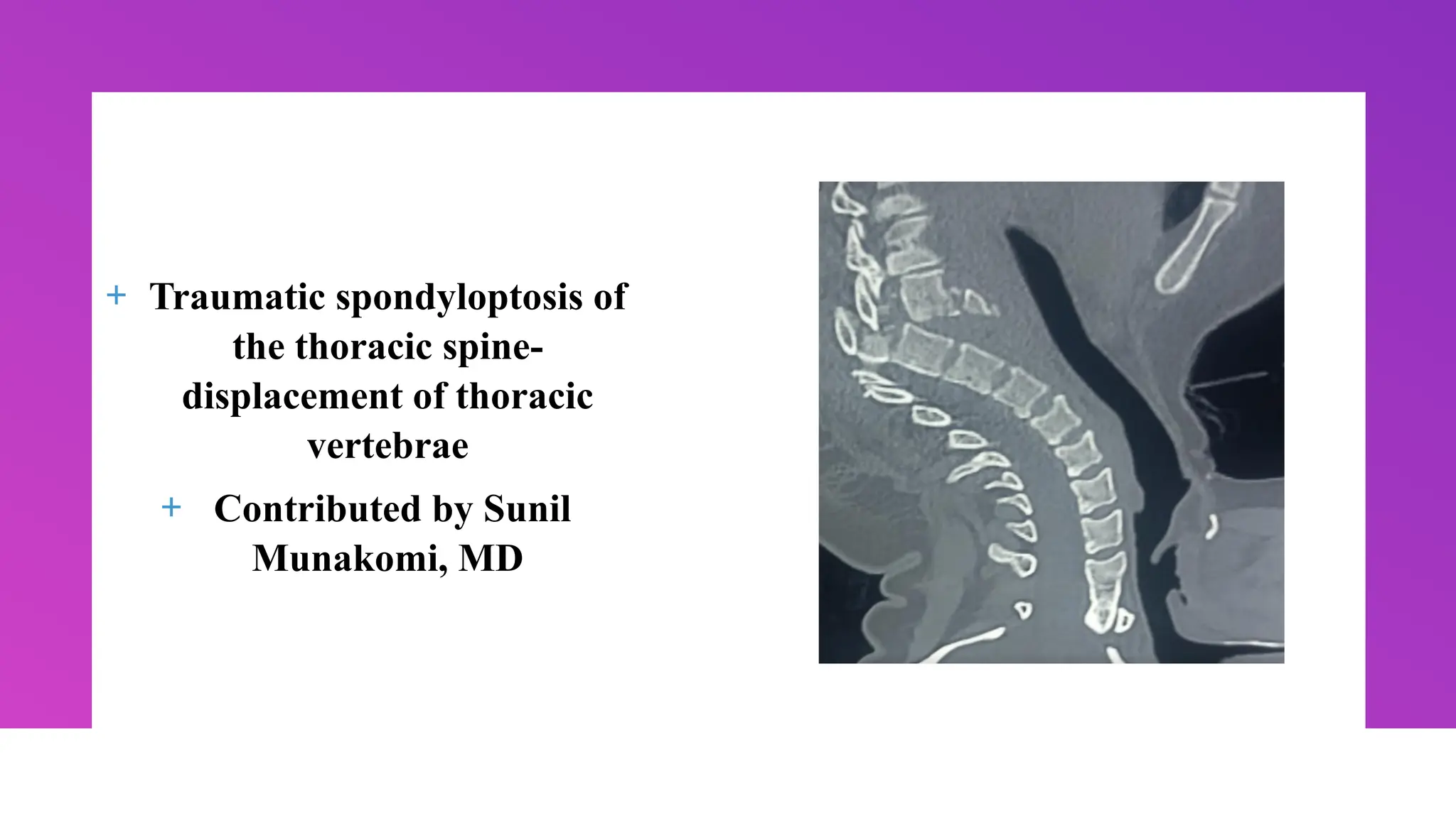 Nursing care of patient with spinal cord injury.pptx