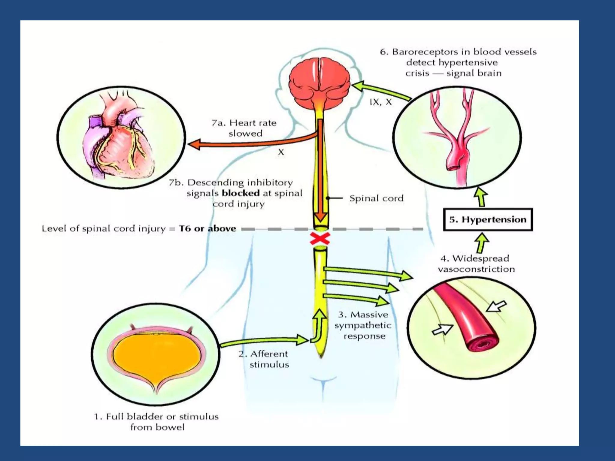 Nursing care of spinal cord injury | PPTX
