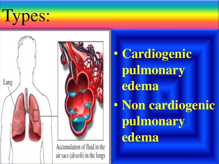Cardiogenic Pulmonary Edema