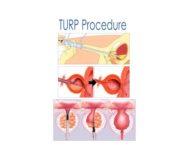 Nursing care process (askep) turp syndrome | PDF