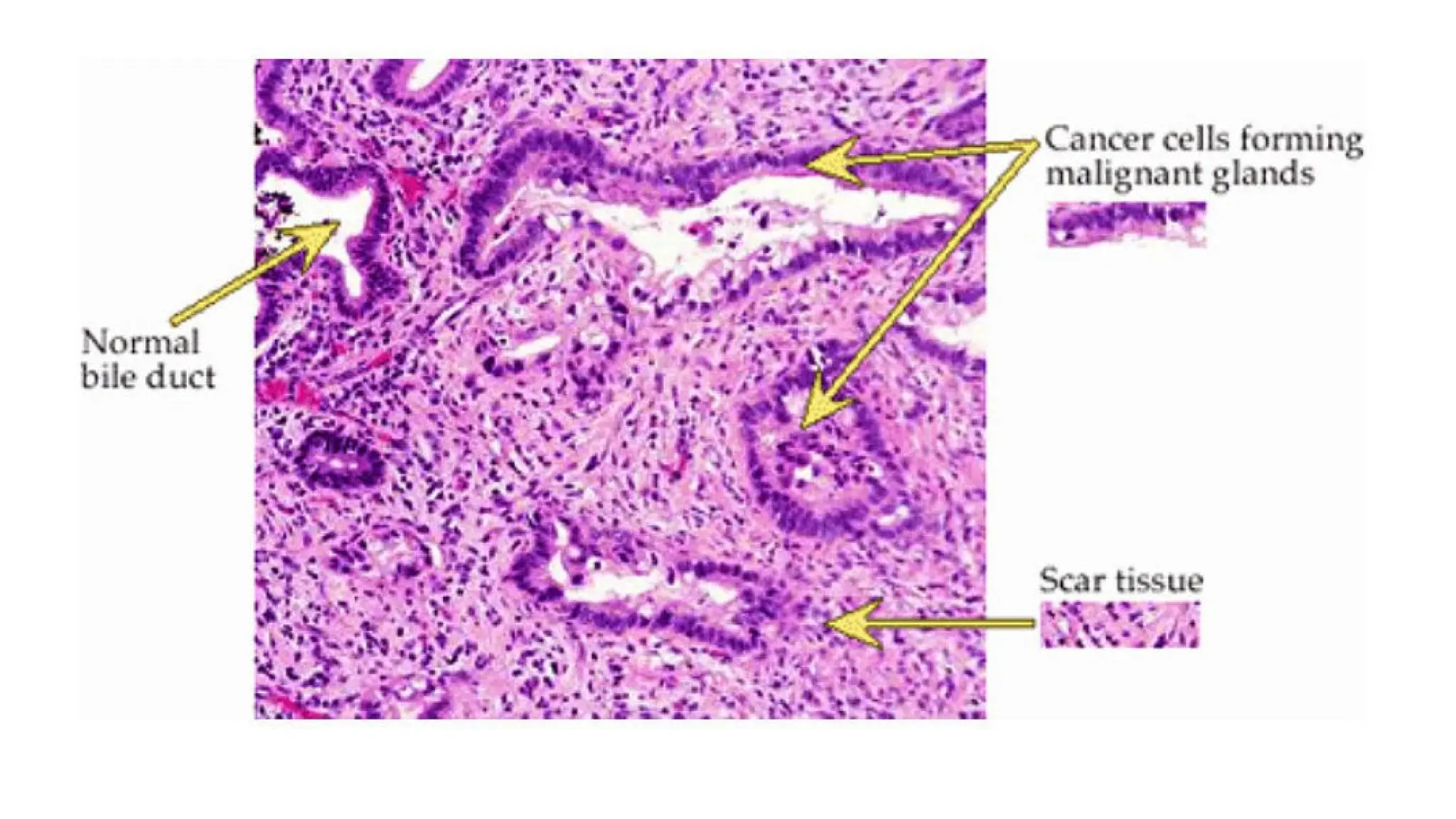 Pathology Nursing class - CANCERS .pptx