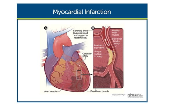 Myocardial Infarction Nursing.pptx | Heart and Cardiovascular Diseases ...