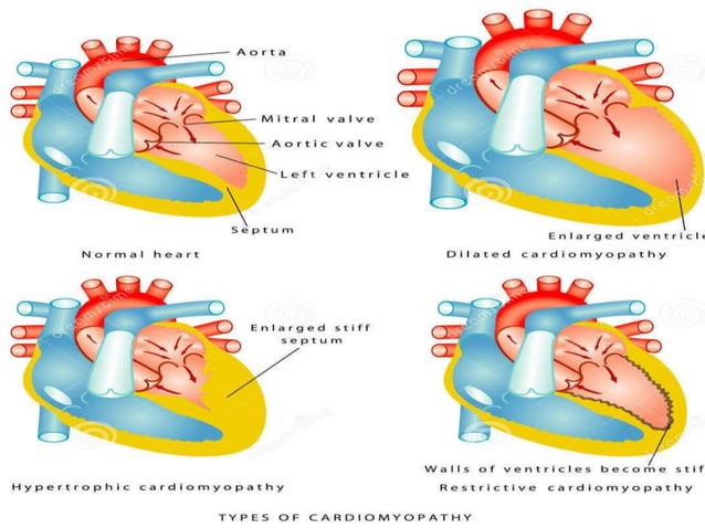 Nursing management of a patient with cardiomyopathy | PPTX | Heart and ...
