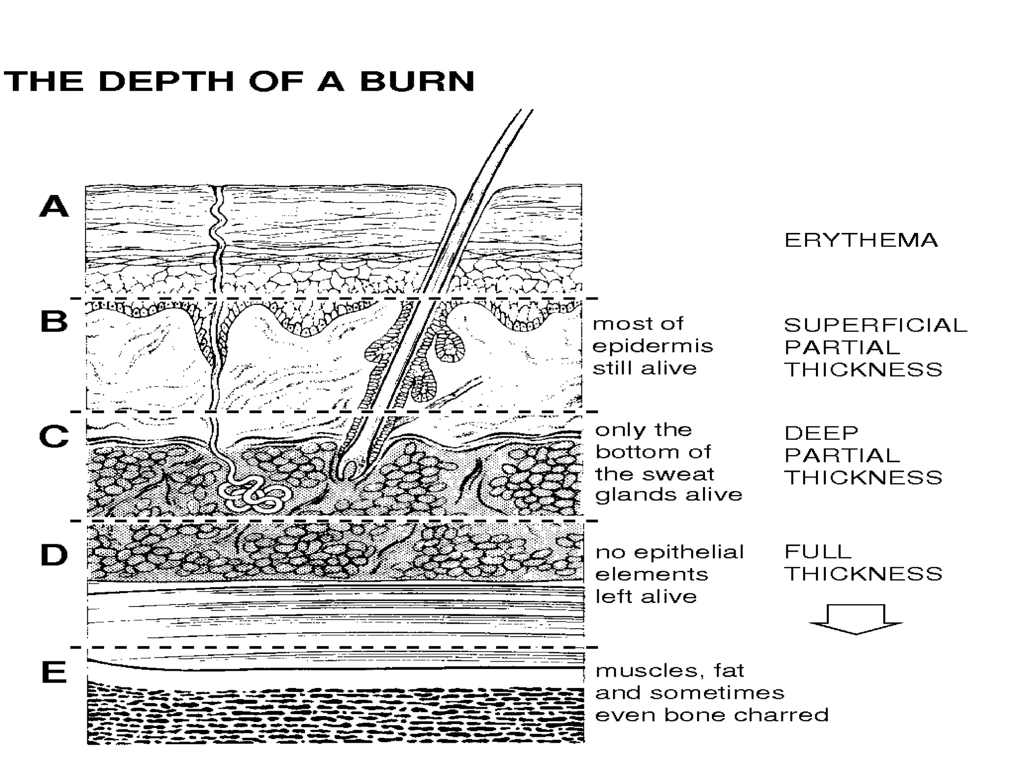 Nursing management of patient with Burns | PPTX