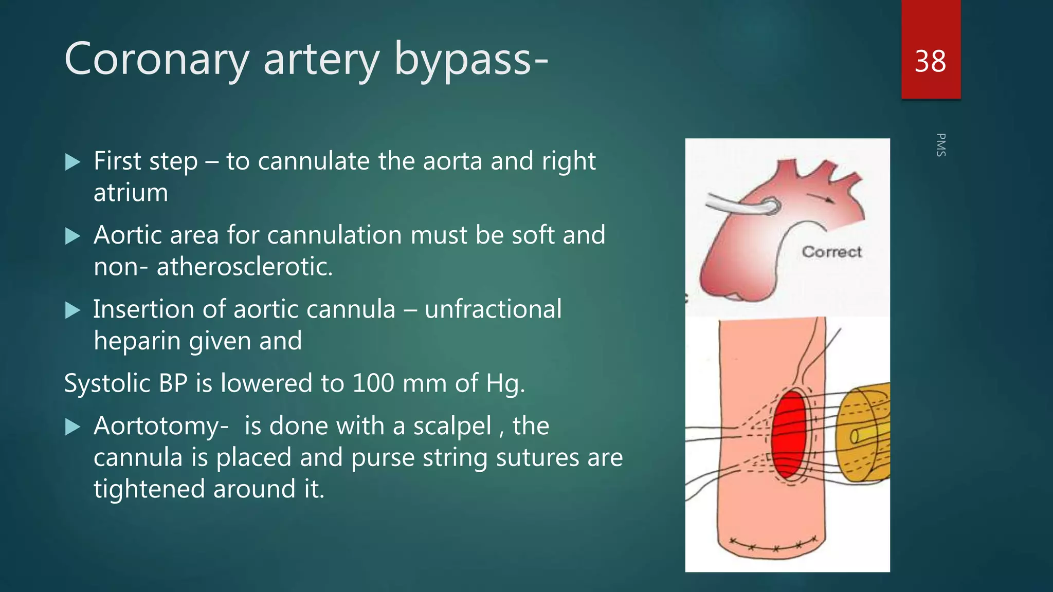 Nursing management of patient with cardiac surgeries. | PPTX