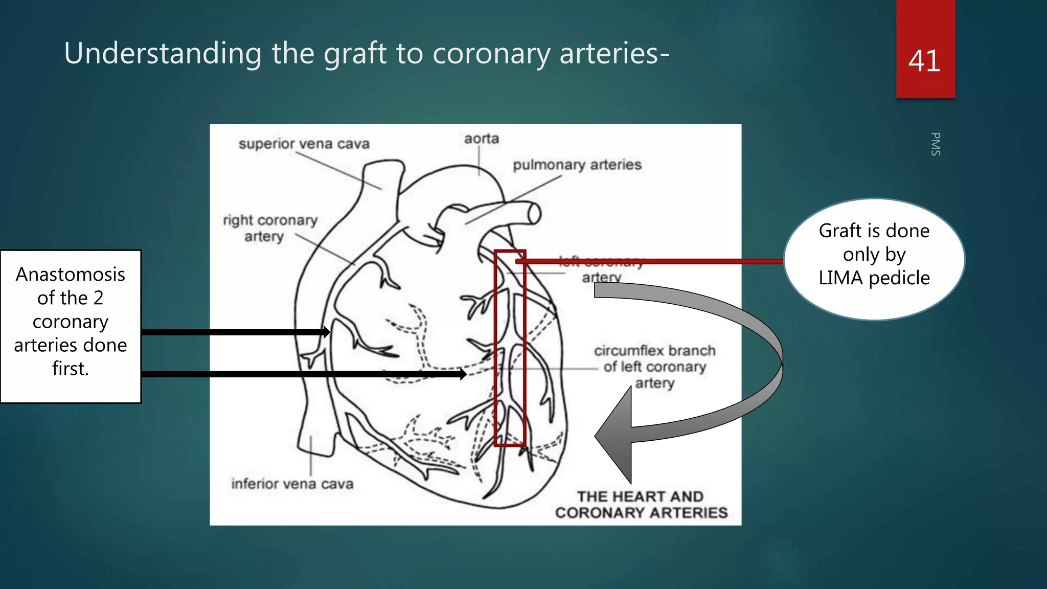 Nursing management of patient with cardiac surgeries. | PPTX