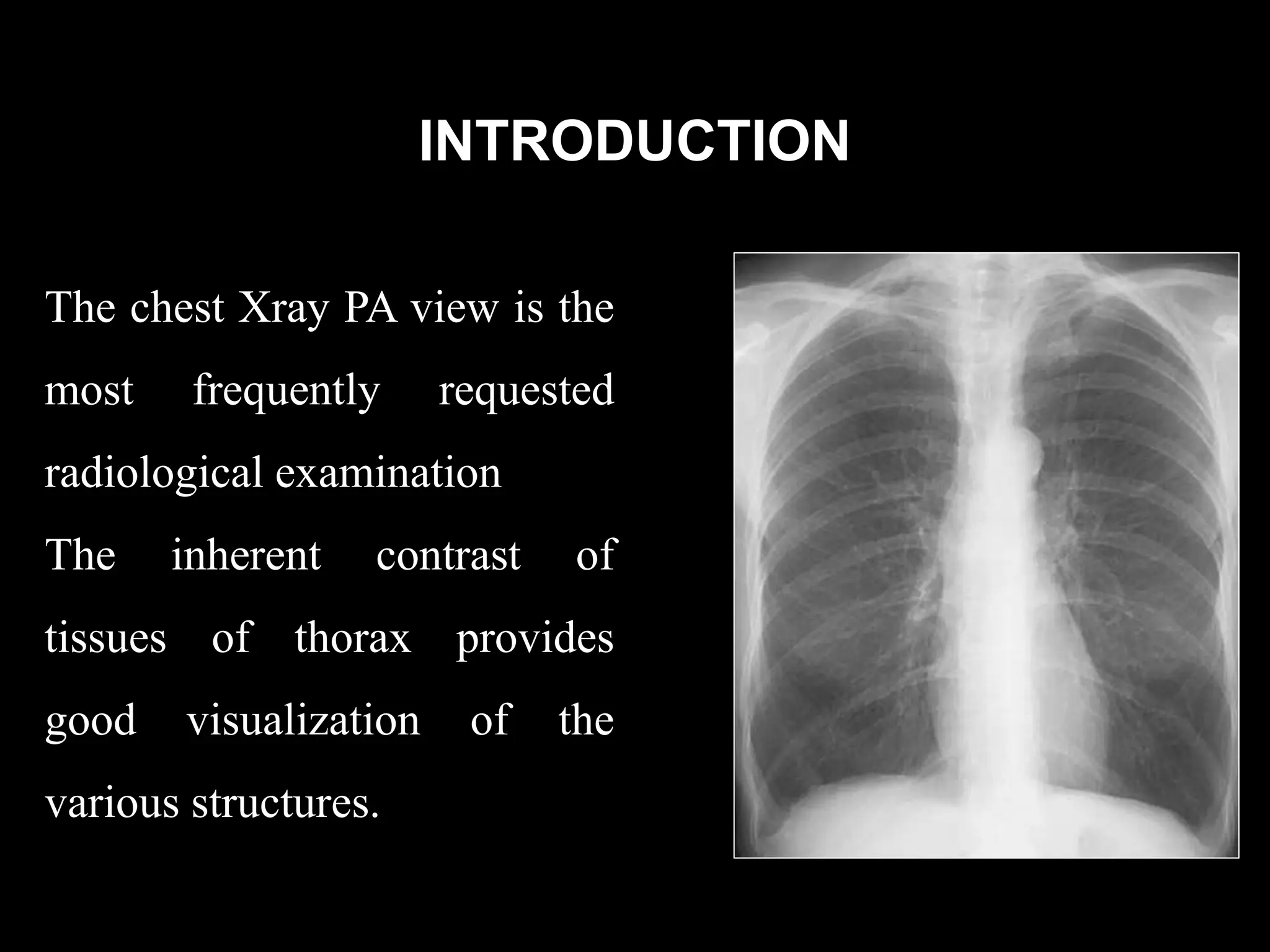 Interpretation of chest xray.For radiologist | PPT