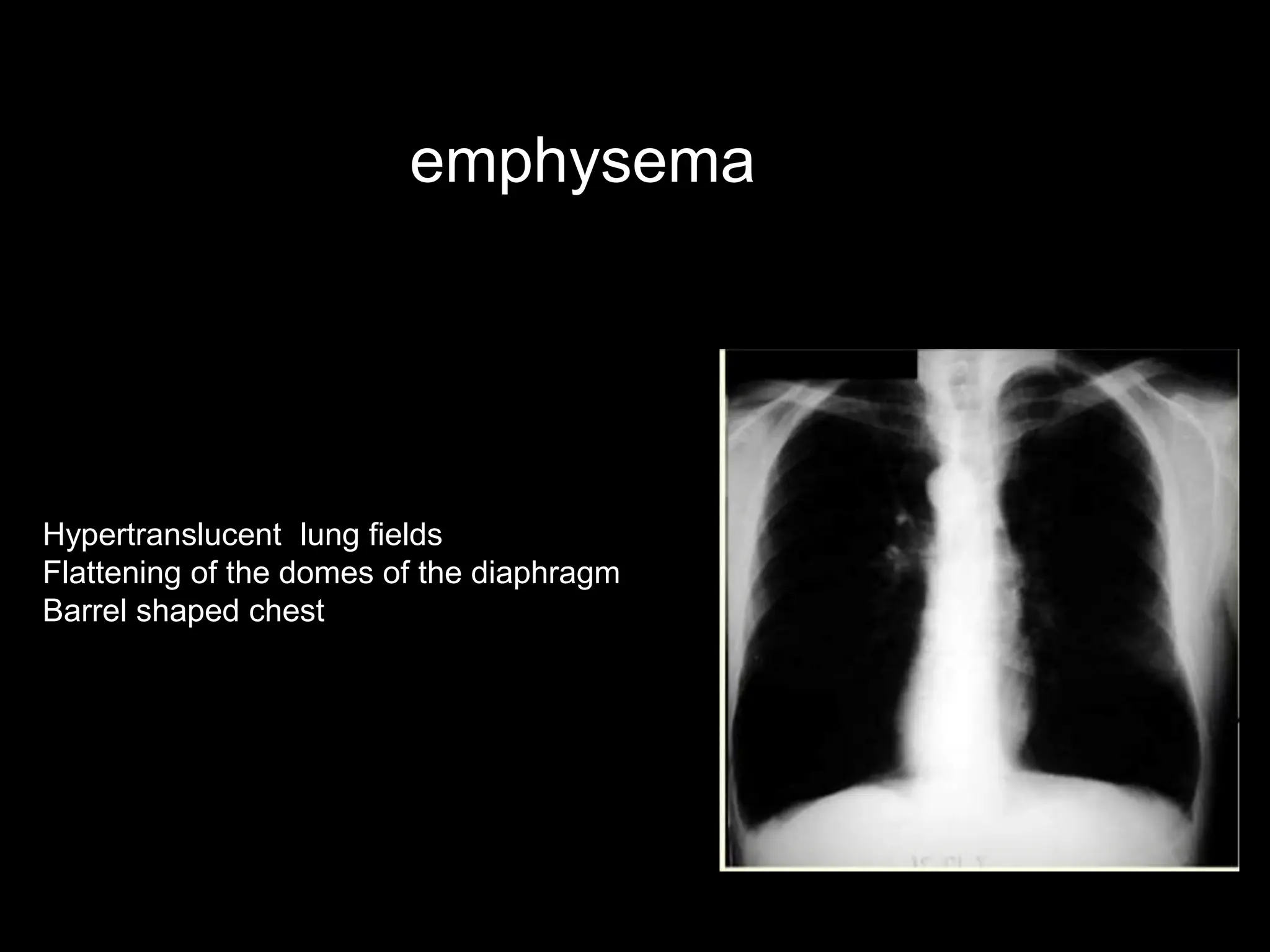 Interpretation of chest xray.For radiologist | PPTX
