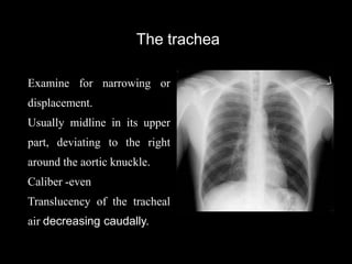 Interpretation of chest xray.For radiologist | PPTX