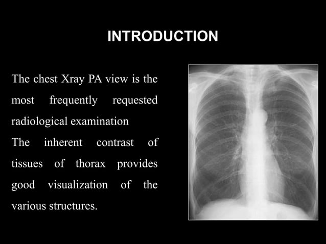 Interpretation of chest xray.For radiologist | PPT