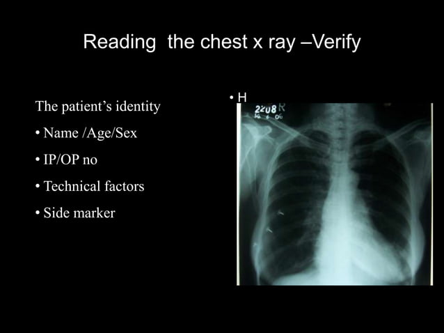Interpretation of chest xray.For radiologist | PPT